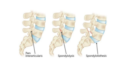 Back pain in gymnastics - Gymnastics Medicine