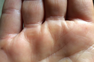 Rip Care 101: While In (and Out) of Season - Gymnastics Medicine
